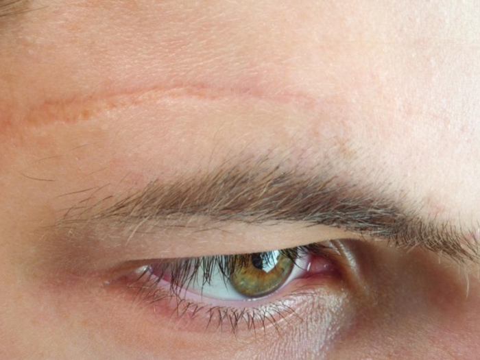 Scars and Soft Tissue Deformities, Cyprus - Dr. Merezas