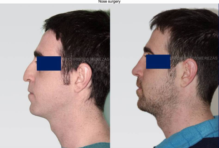 Rhinoplasty in Limassol, Nose, Cyprus - Dr. Merezas