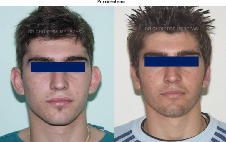 Prominent ears 1 - MEREZAS CLINIC plastic surgeon Cyprus Limassol
